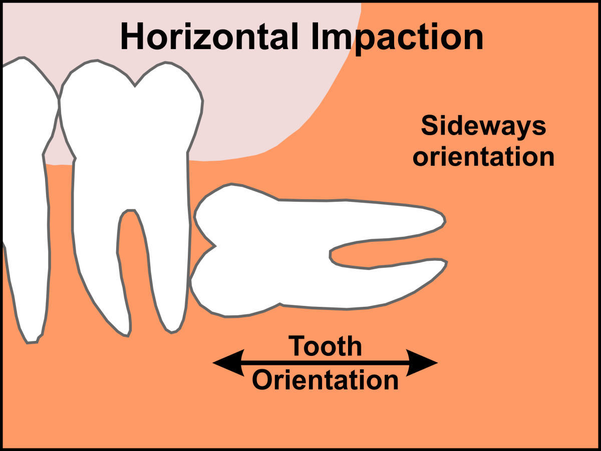 Types of Wisdom Teeth - Wisdom Teeth Factory