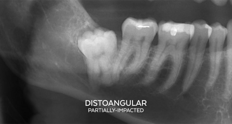 Types of Wisdom Teeth - Wisdom Teeth Factory