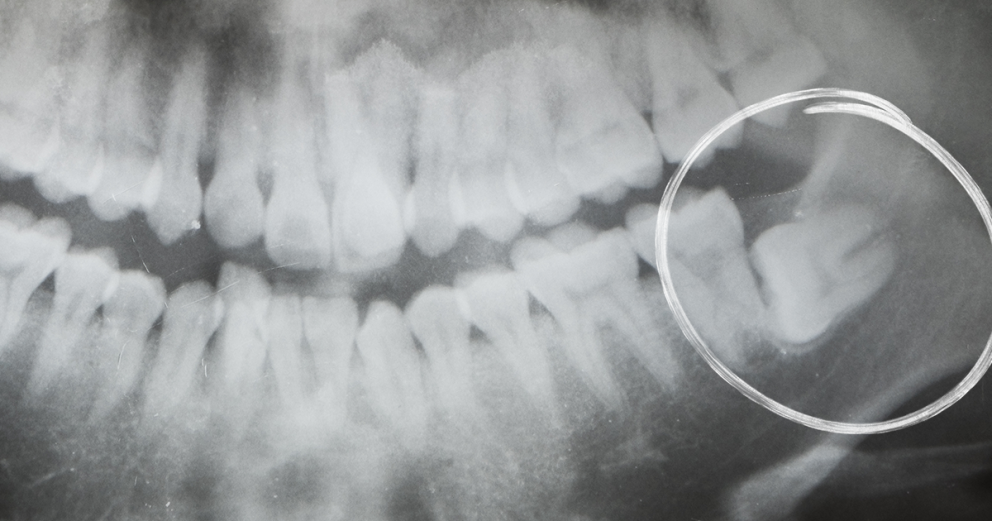 Horizontal Wisdom Teeth - Wisdom Teeth Factory