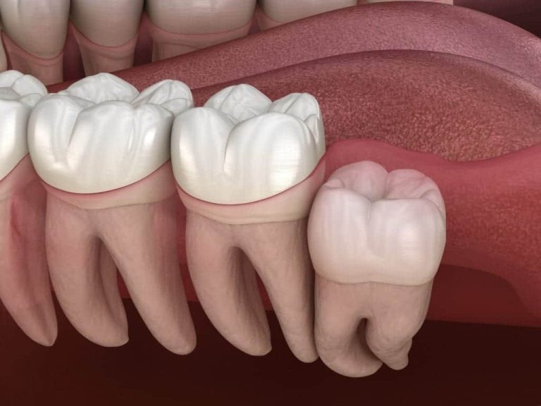 Wisdom Teeth Removal Recovery Timeline