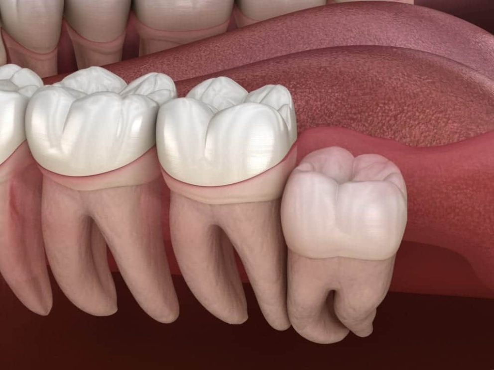 Wisdom Teeth Removal Recovery Timeline