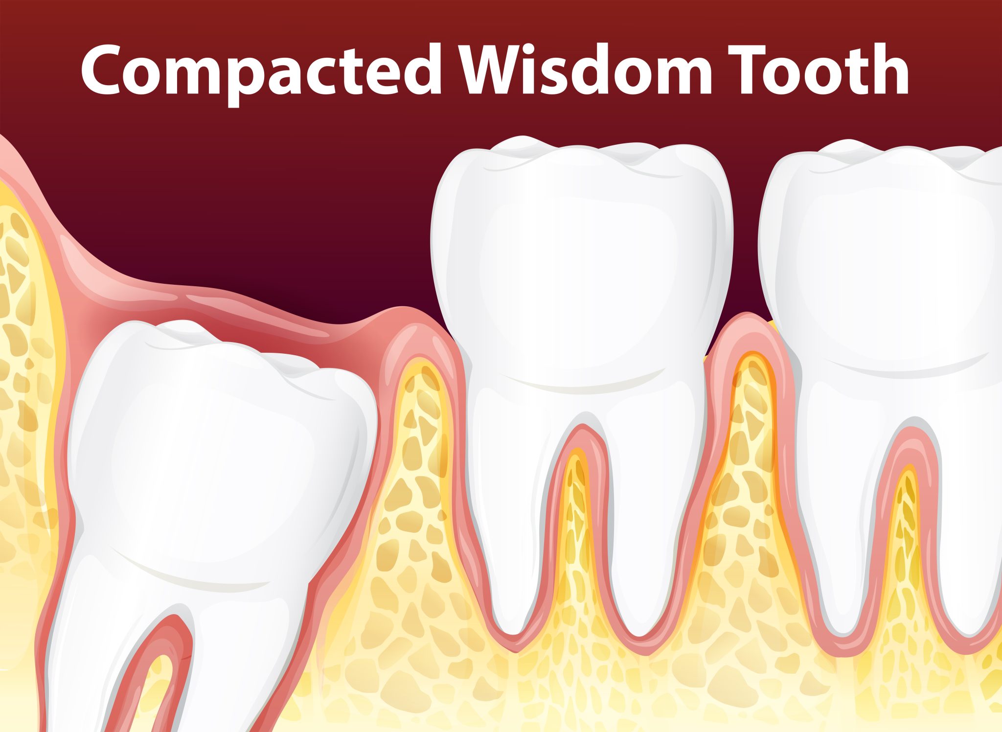 No Referral Wisdom Tooth Extraction - Wisdom Teeth Factory in Houston